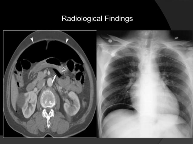 Imaging Of Peritoneal Pathology | PPTX