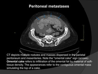 Imaging Of Peritoneal Pathology | PPTX