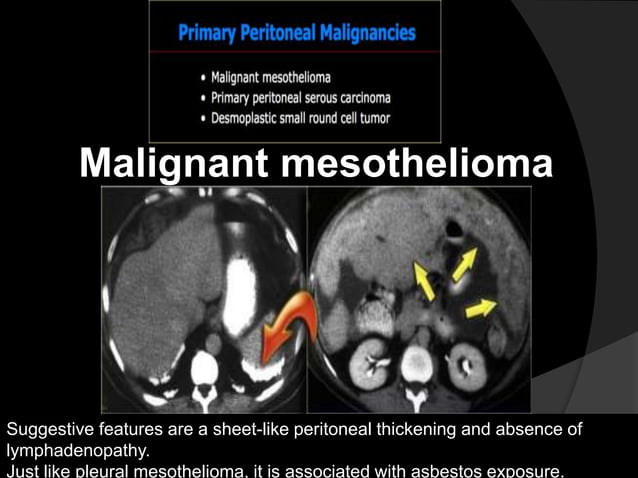 Imaging Of Peritoneal Pathology | PPTX