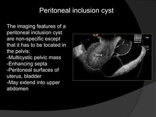 Imaging Of Peritoneal Pathology | PPT