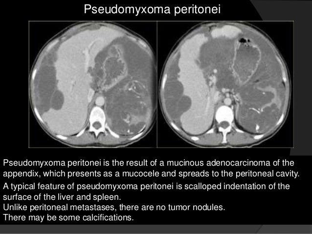 Imaging Of Peritoneal Pathology