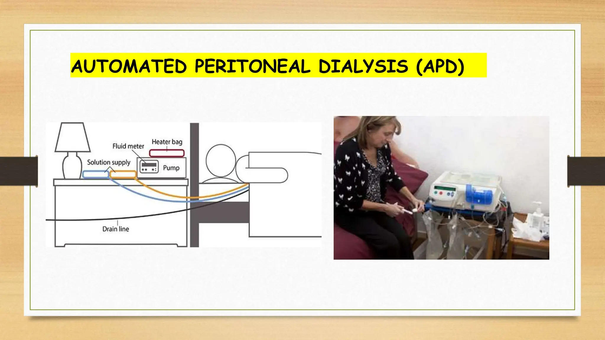 Nursing management of patient with peritoneal dialysis | PPTX