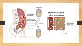 Nursing management of patient with peritoneal dialysis | PPTX