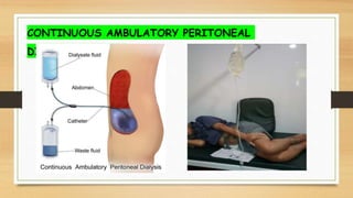 Nursing management of patient with peritoneal dialysis | PPTX