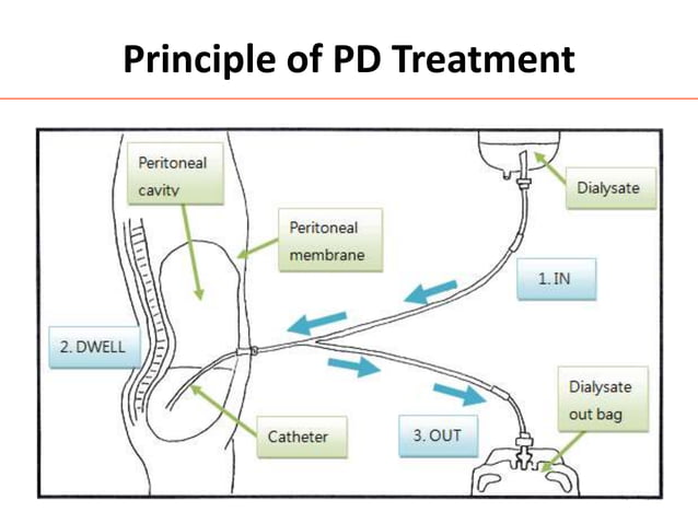 Peritoneal dialysis by Dr. Basil Tumaini | PPT