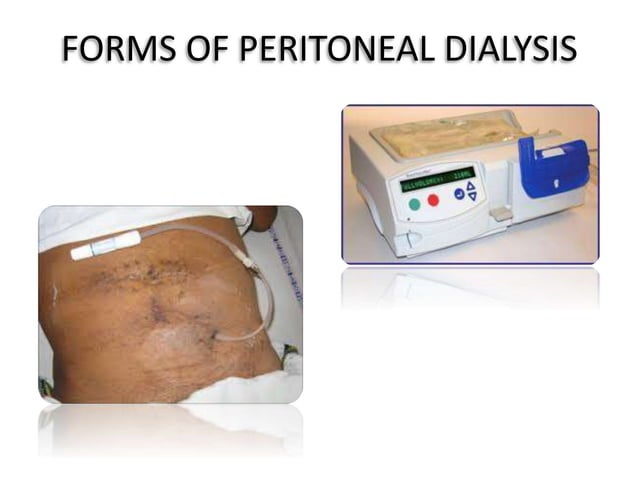 Peritoneal dialysis by Dr. Basil Tumaini | PPT