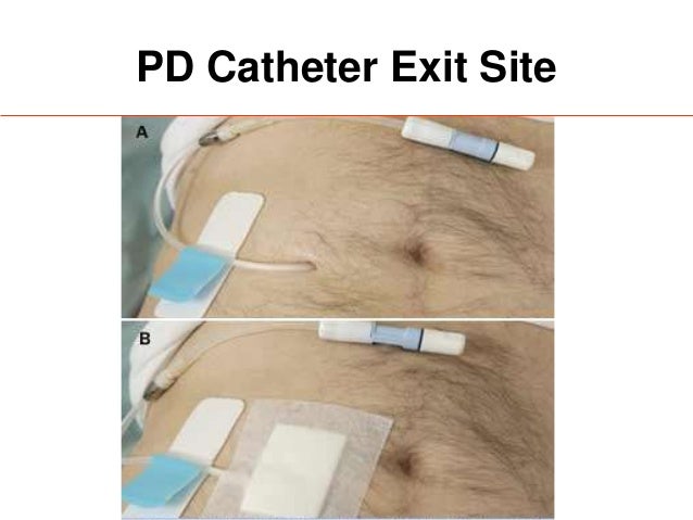 Peritoneal dialysis by Dr. Basil Tumaini