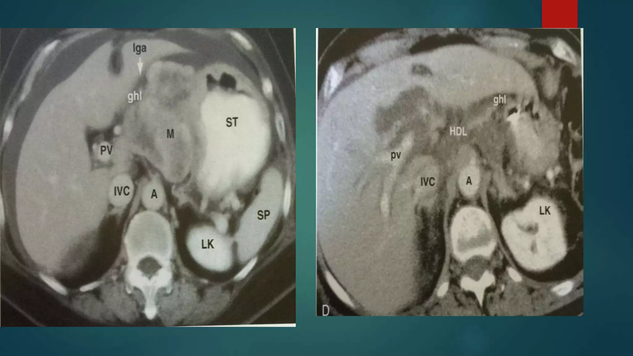 anatomy of Peritoneal spaces | PPTX