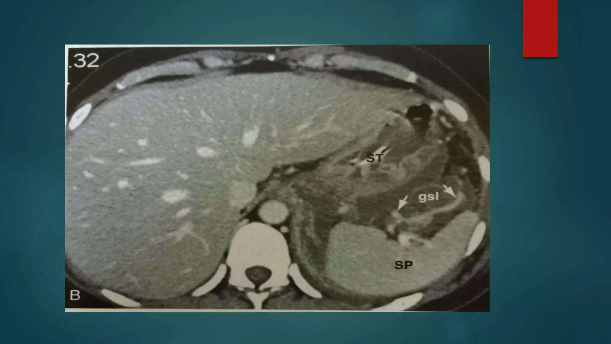 anatomy of Peritoneal spaces | PPTX