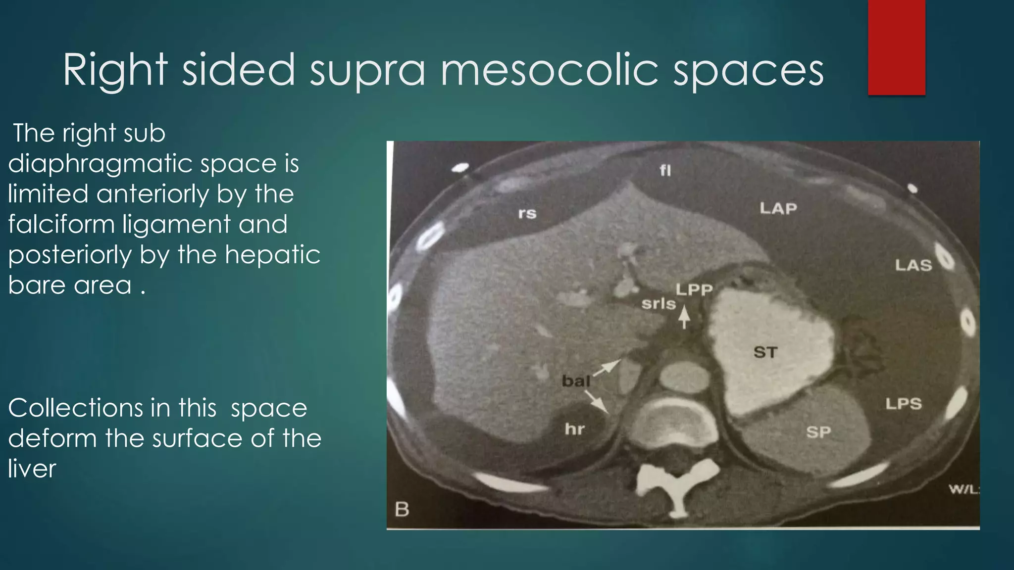 anatomy of Peritoneal spaces | PPTX