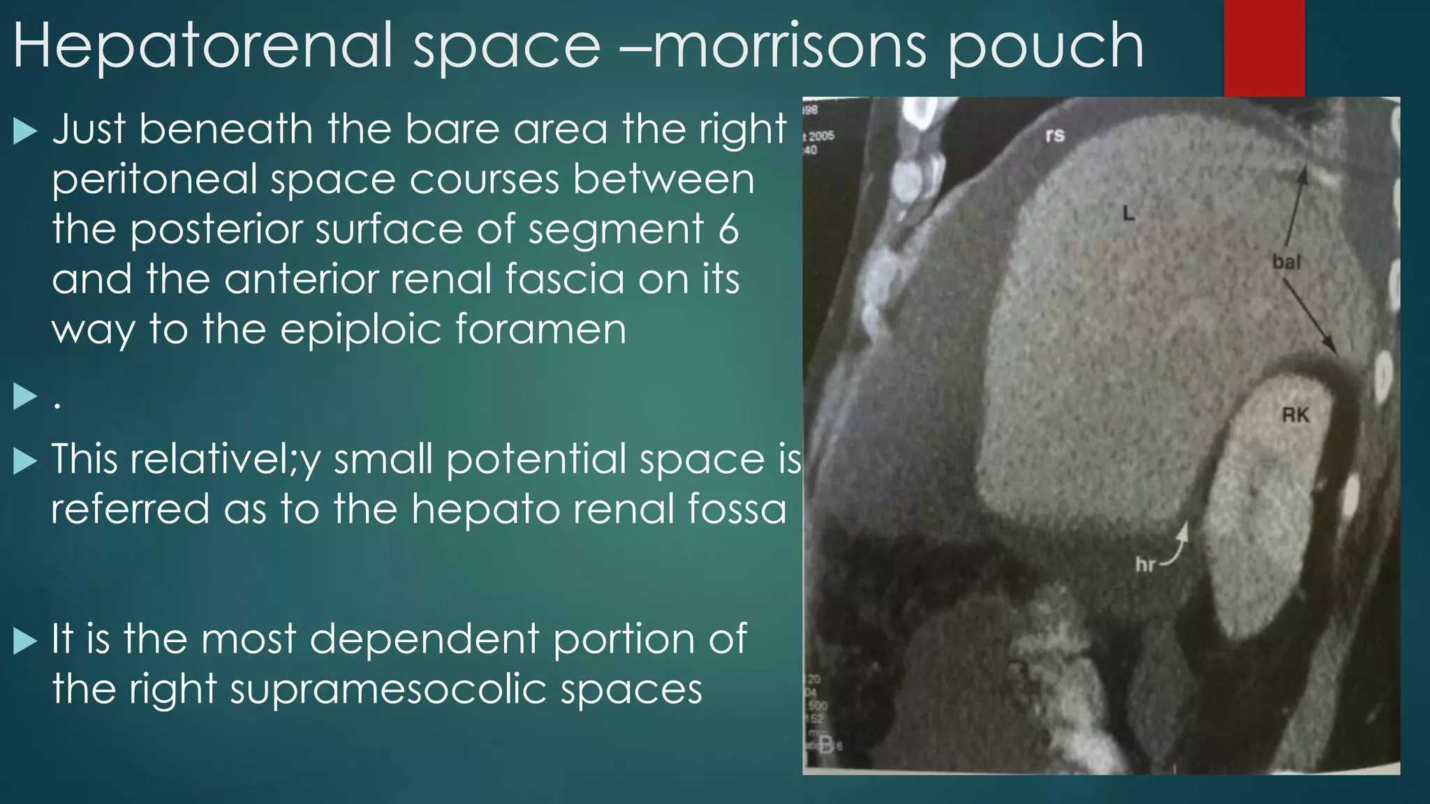 anatomy of Peritoneal spaces | PPTX