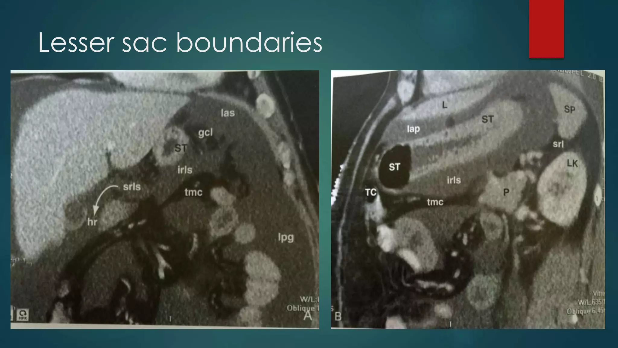 anatomy of Peritoneal spaces | PPTX