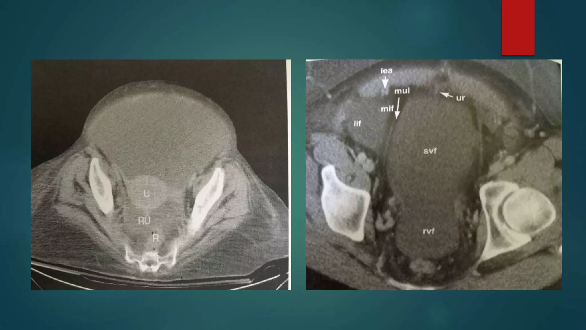 anatomy of Peritoneal spaces | PPTX