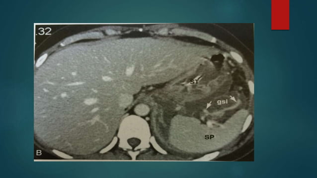 anatomy of Peritoneal spaces | PPTX | Reproductive Health | Diseases ...