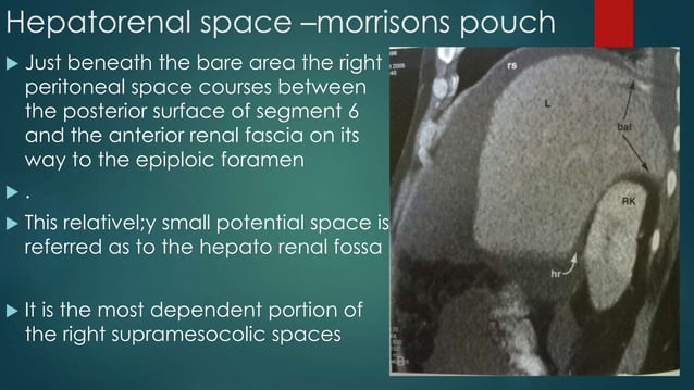 anatomy of Peritoneal spaces | PPTX | Reproductive Health | Diseases ...