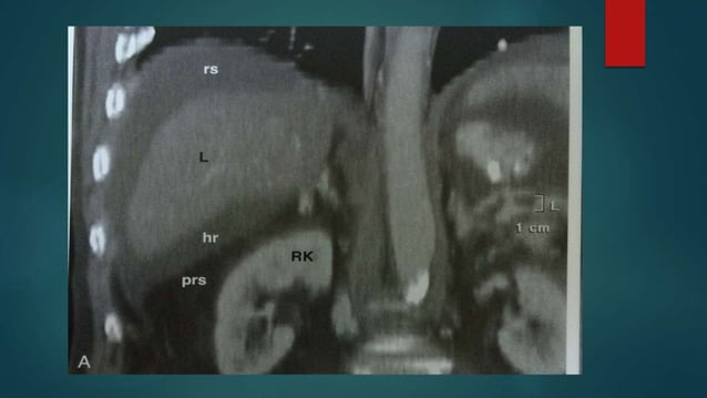 anatomy of Peritoneal spaces | PPTX | Reproductive Health | Diseases ...