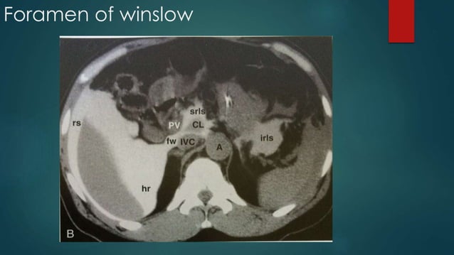anatomy of Peritoneal spaces | PPTX | Reproductive Health | Diseases ...