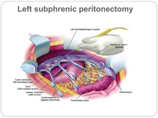 Peritoneal surface malignancy | PPTX