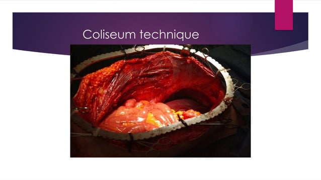 Peritonectomy and HIPEC procedure description.pptx