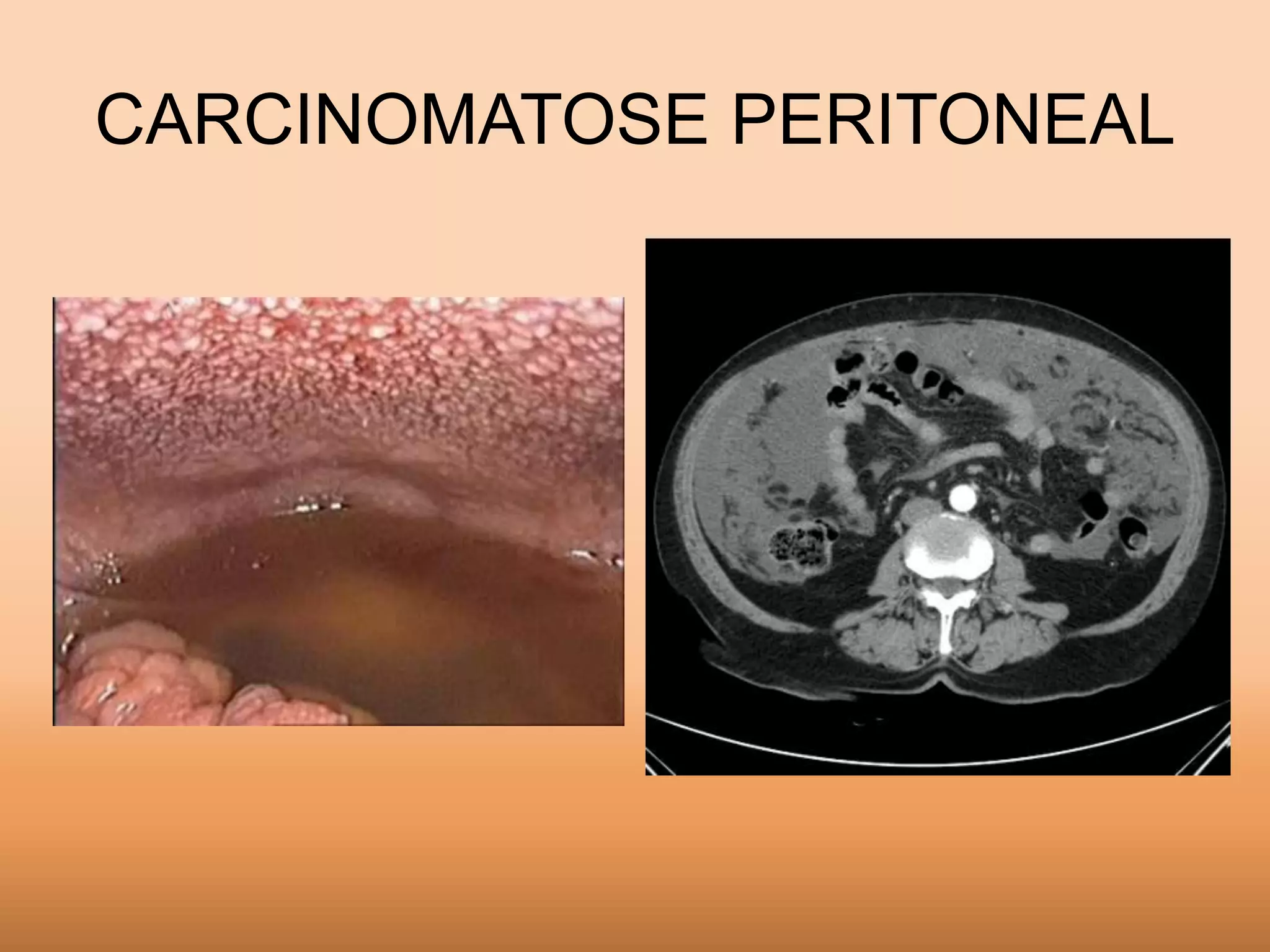 Carcinomatose Peritoneal e outras Anomalias | PPT