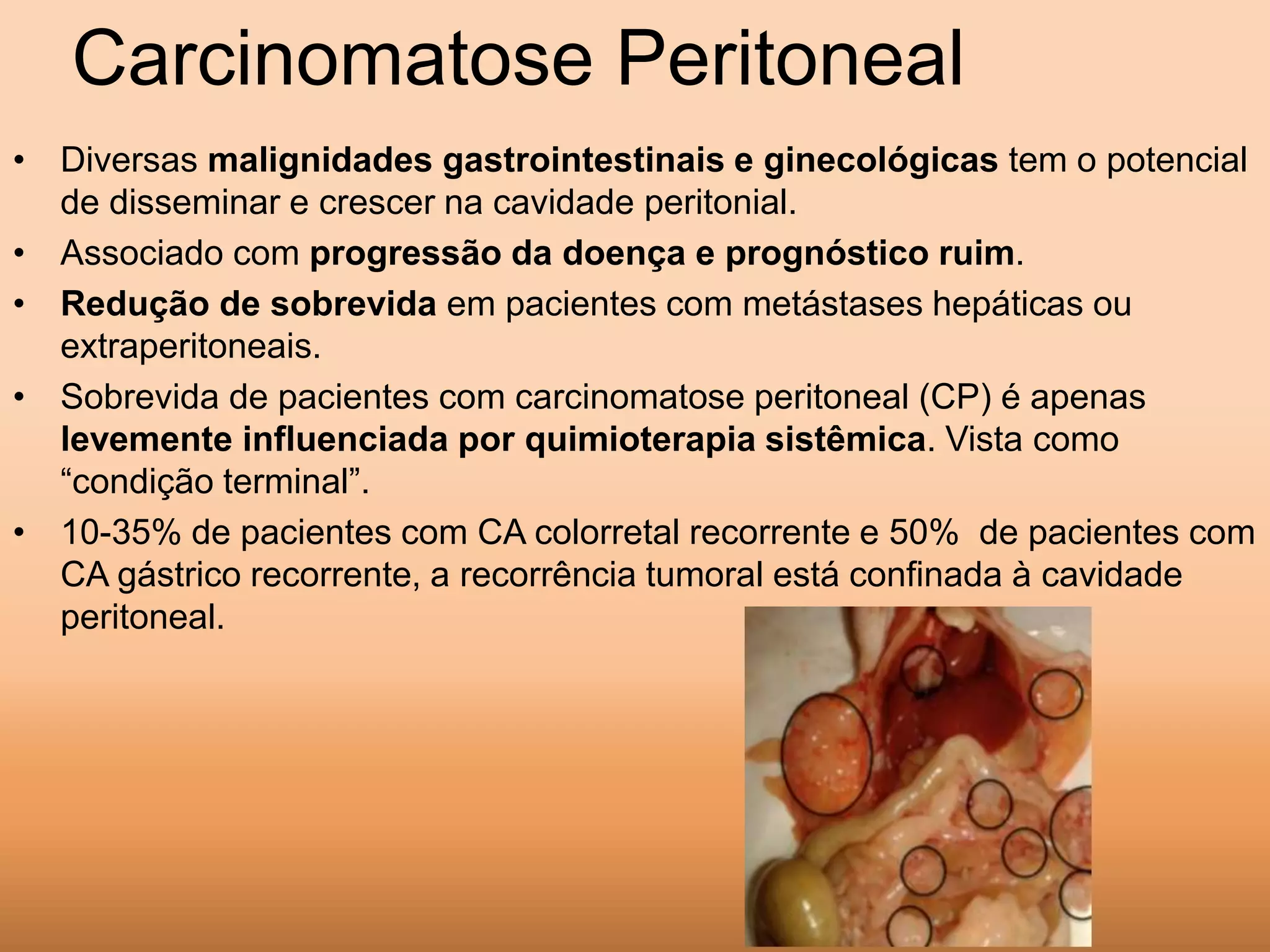 Carcinomatose Peritoneal E Outras Anomalias Ppt