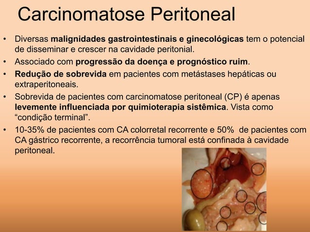 Carcinomatose Peritoneal e outras Anomalias | PPT