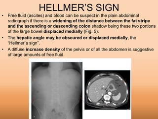 Carcinomatose Peritoneal e outras Anomalias | PPT