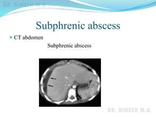 Peritoneum | PPTX | Digestive Disorders | Diseases and Conditions