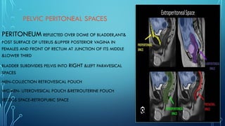 RADIOLOGICAL ANATOMY OF PERITONEUM.pptx