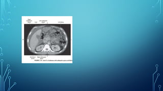 RADIOLOGICAL ANATOMY OF PERITONEUM.pptx