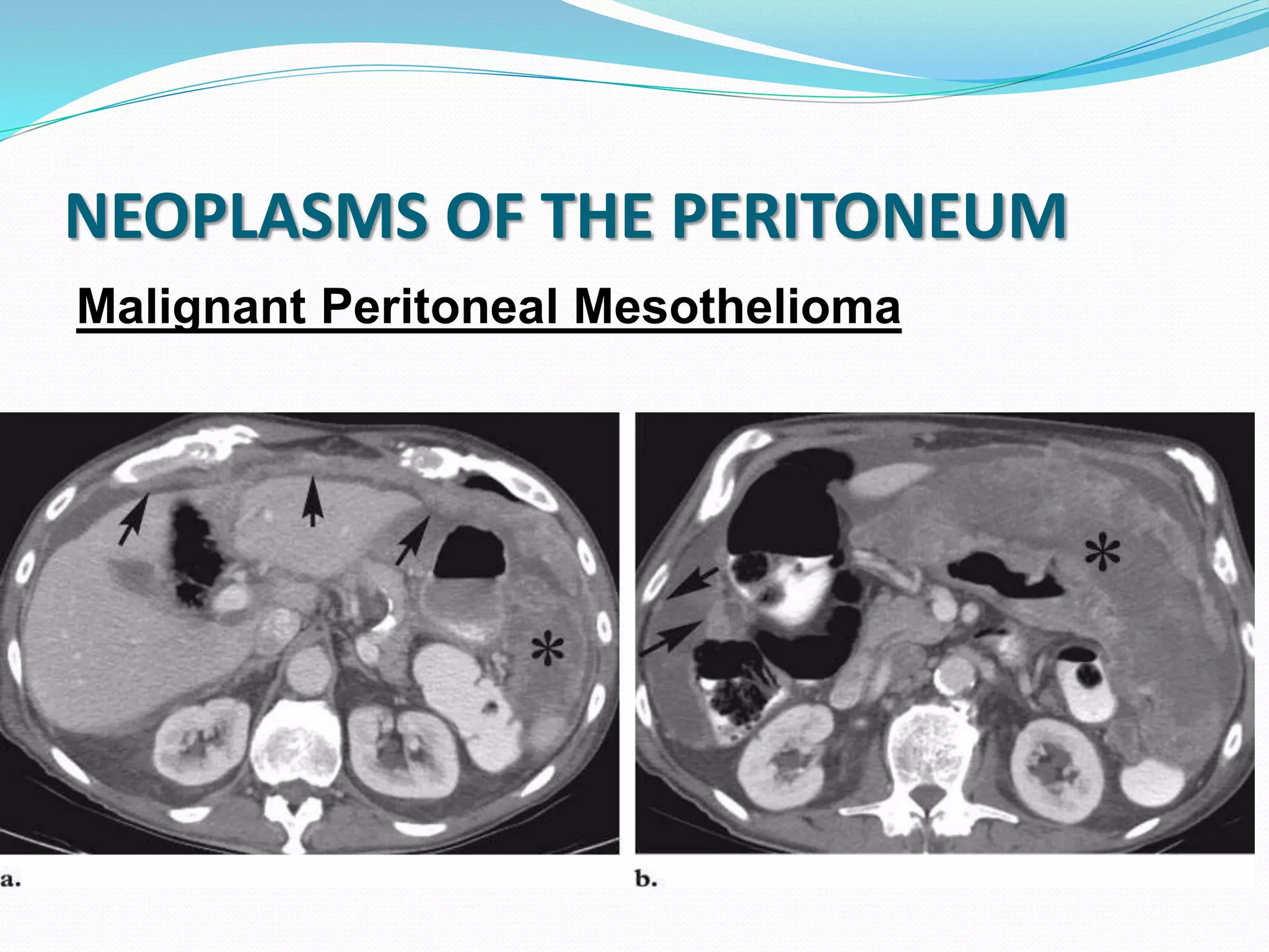 Peritoneum, mesenetry and retroperitoneal tumors | PPTX