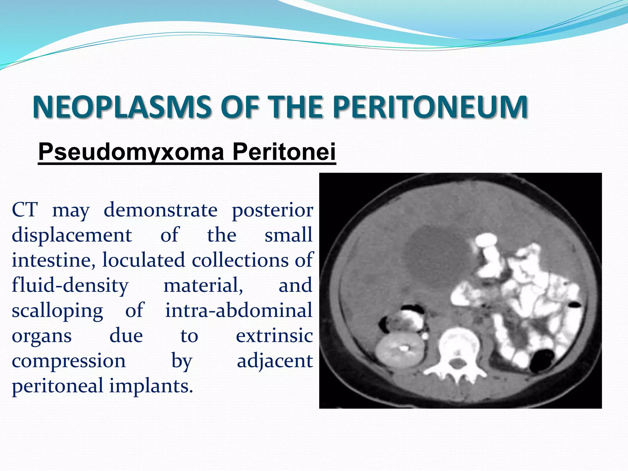 Peritoneum, mesenetry and retroperitoneal tumors | PPTX