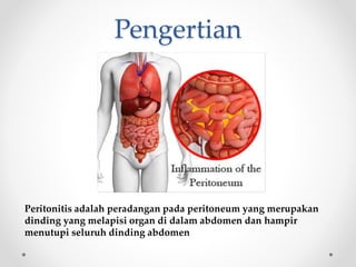Peritonitis-1.pptx