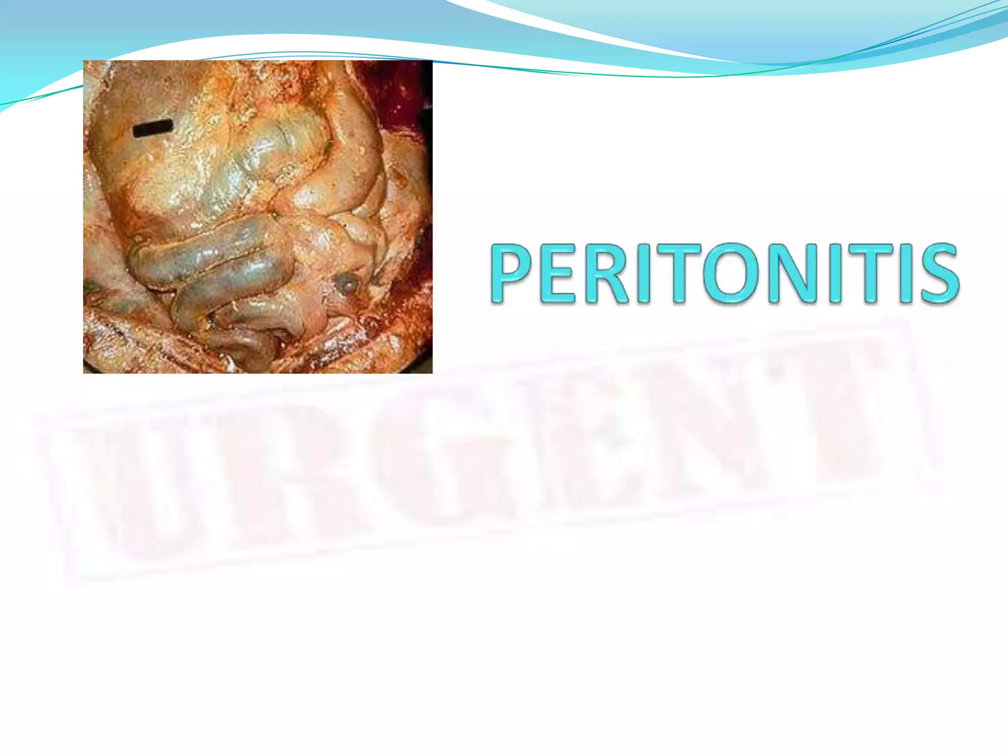 Peritonitis | PPTX