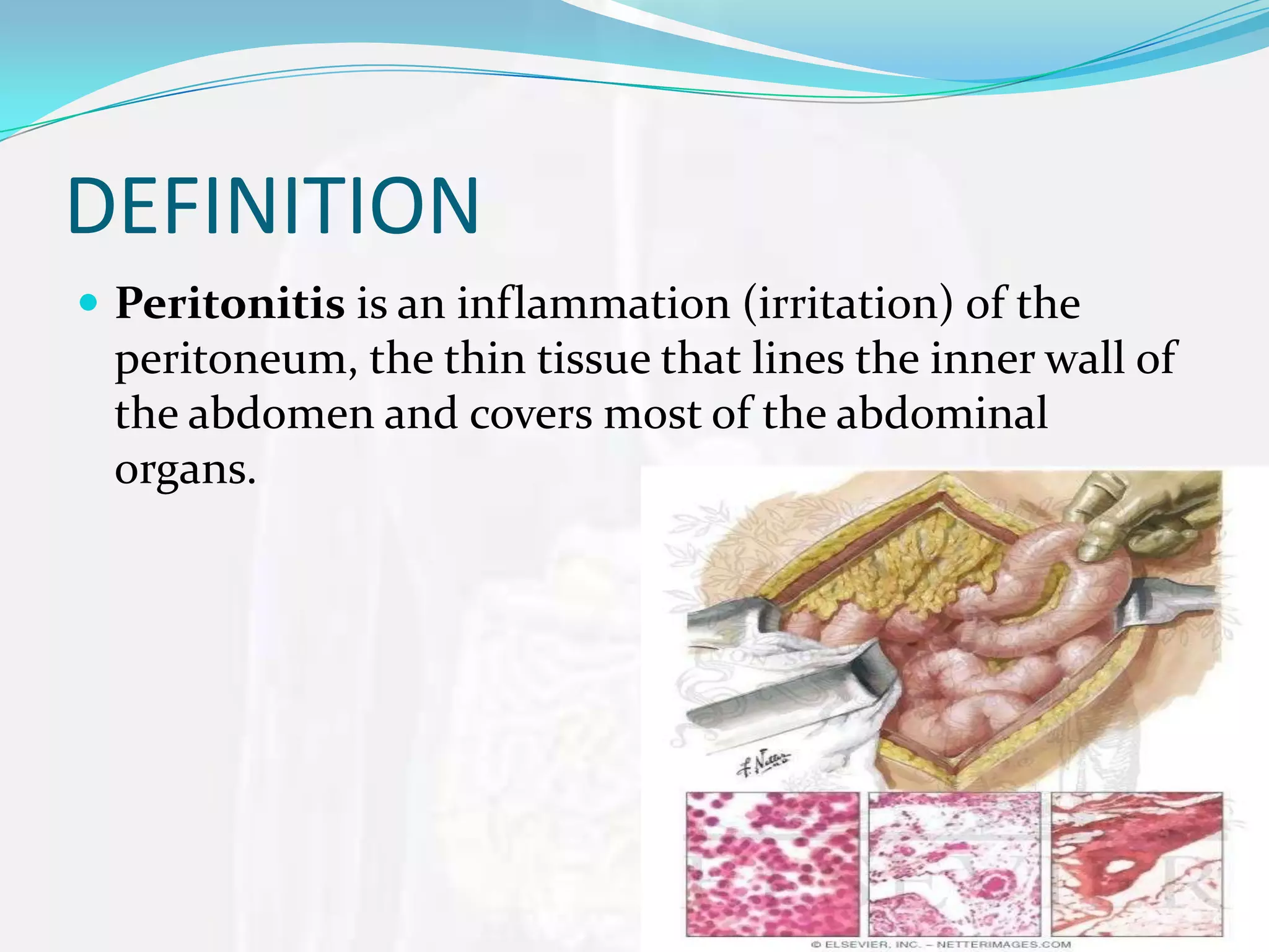 Peritonitis | PPTX