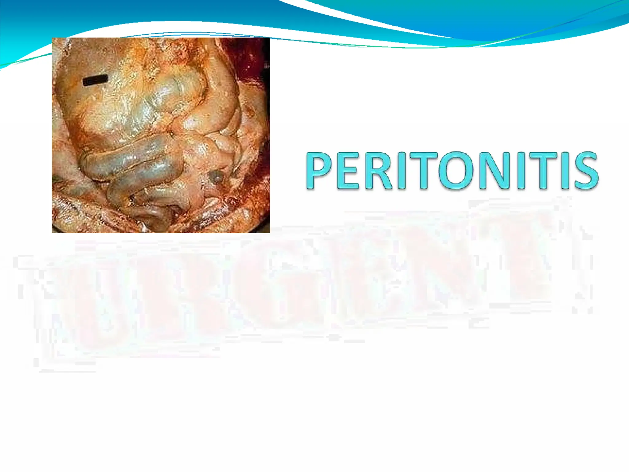 peritonitis-121023045608-phpapp01 (1).pptx