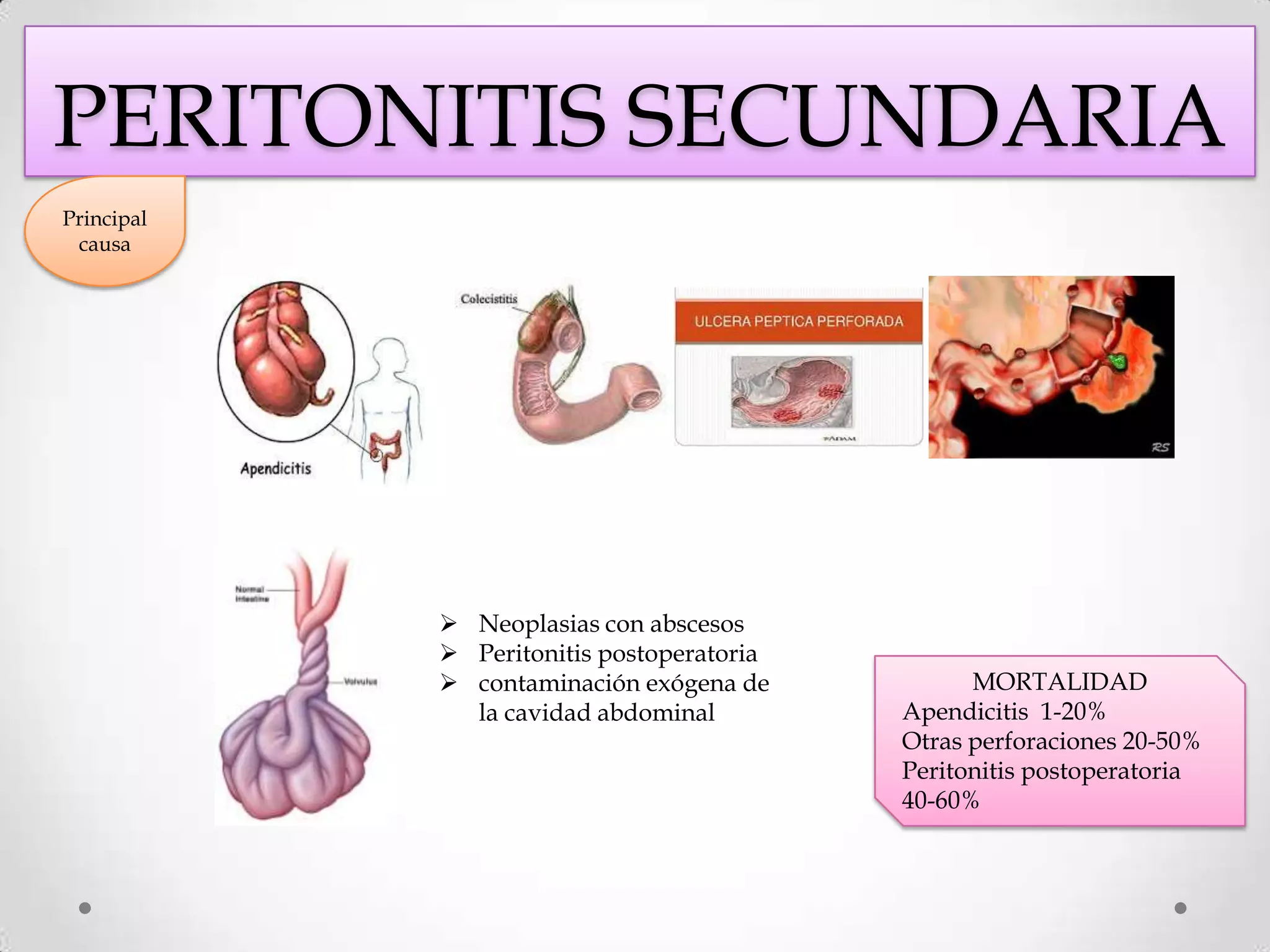 Peritonitis | PPTX