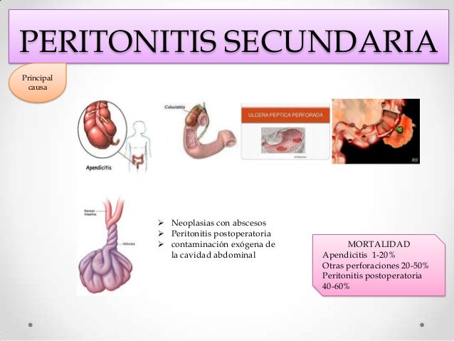 Peritonitis