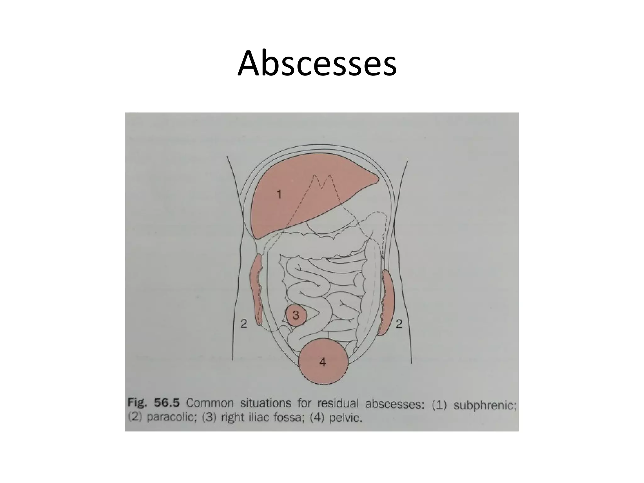 Complication of Acute Peritonitis & Tuberculous Peritonitis | PPT