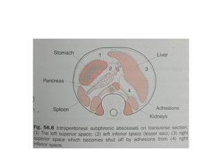 Complication of Acute Peritonitis & Tuberculous Peritonitis | PPT