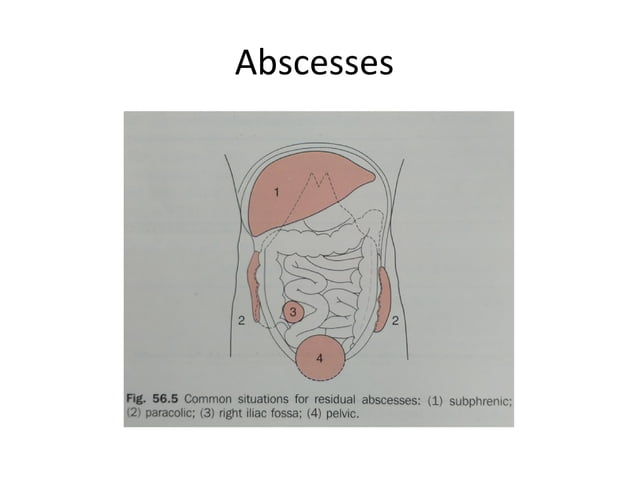Complication of Acute Peritonitis & Tuberculous Peritonitis | PPT