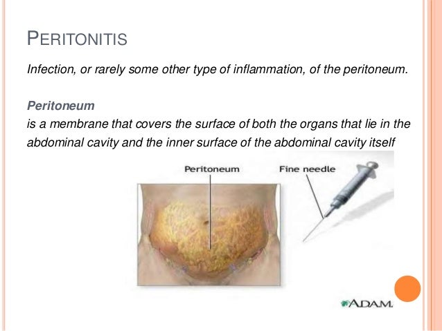Peritonitis