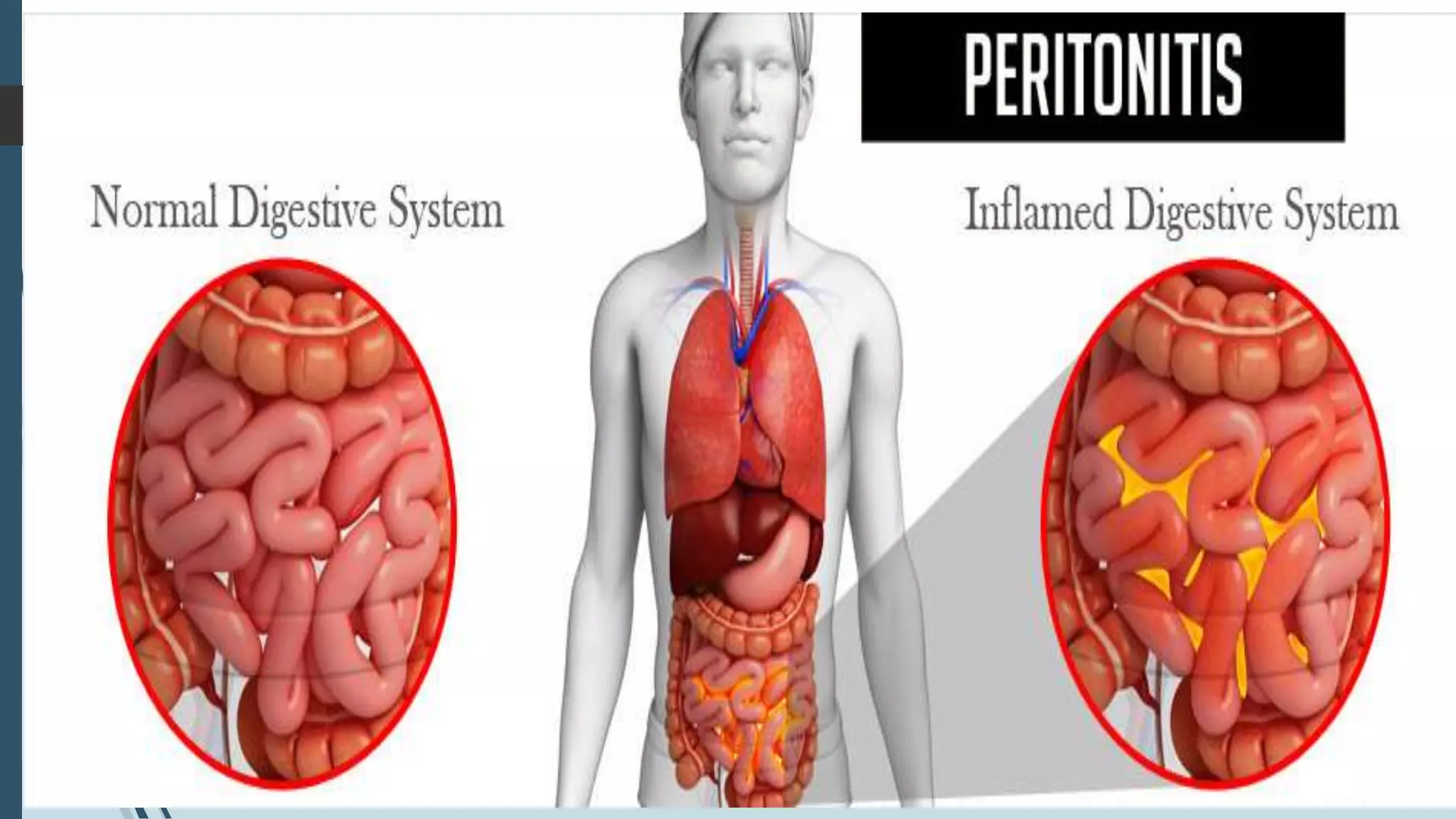 Peritonitis | PPTX
