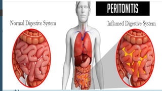 Peritonitis | PPTX