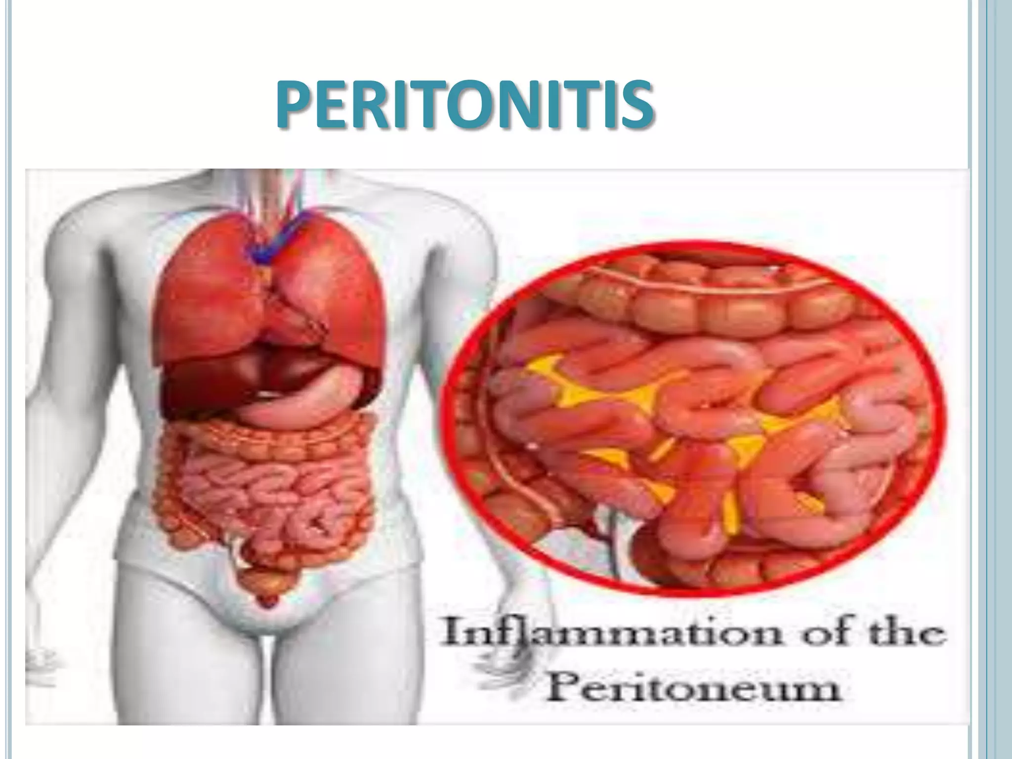 Peritonitis | PPTX