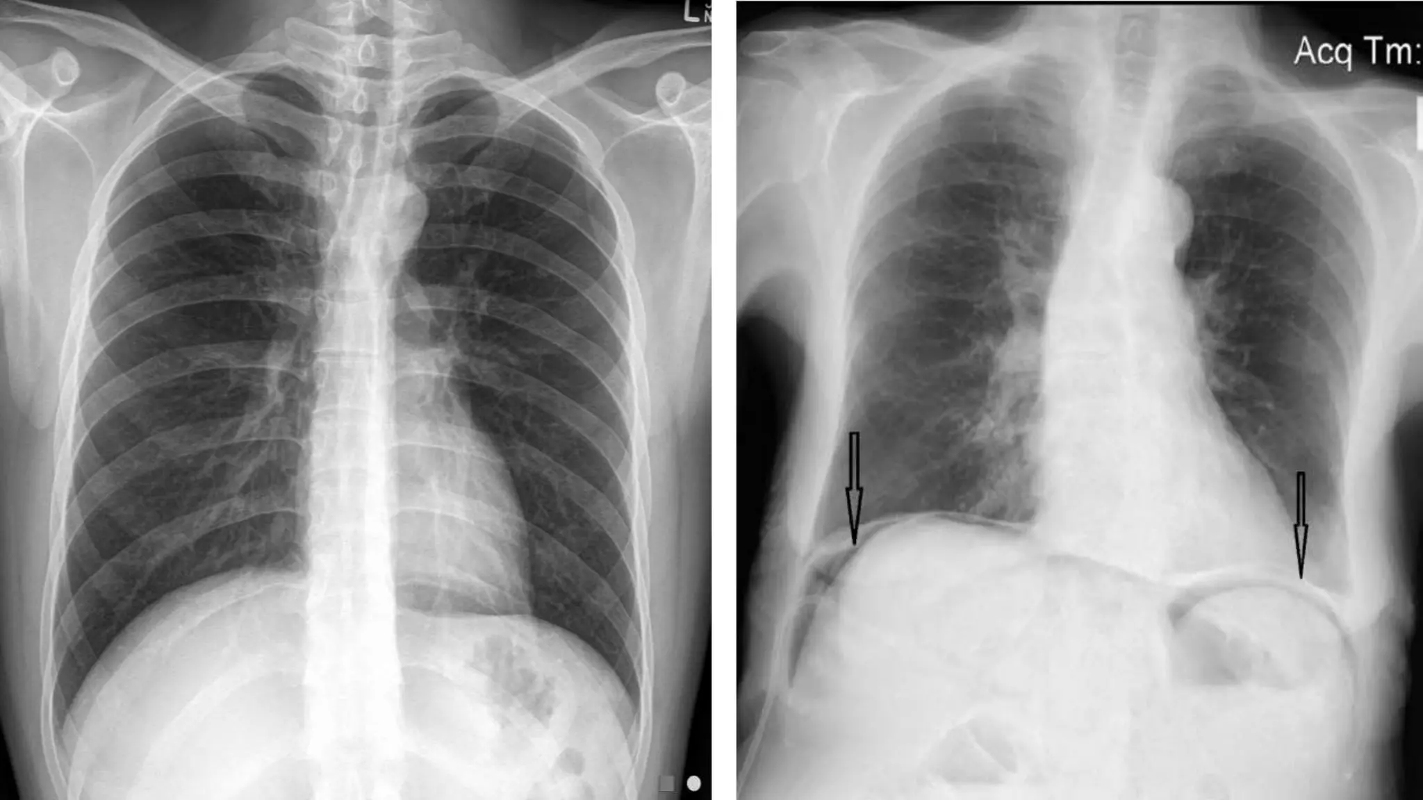 Peritonitis | PPTX