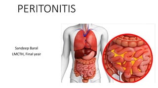 Peritonitis | PPTX