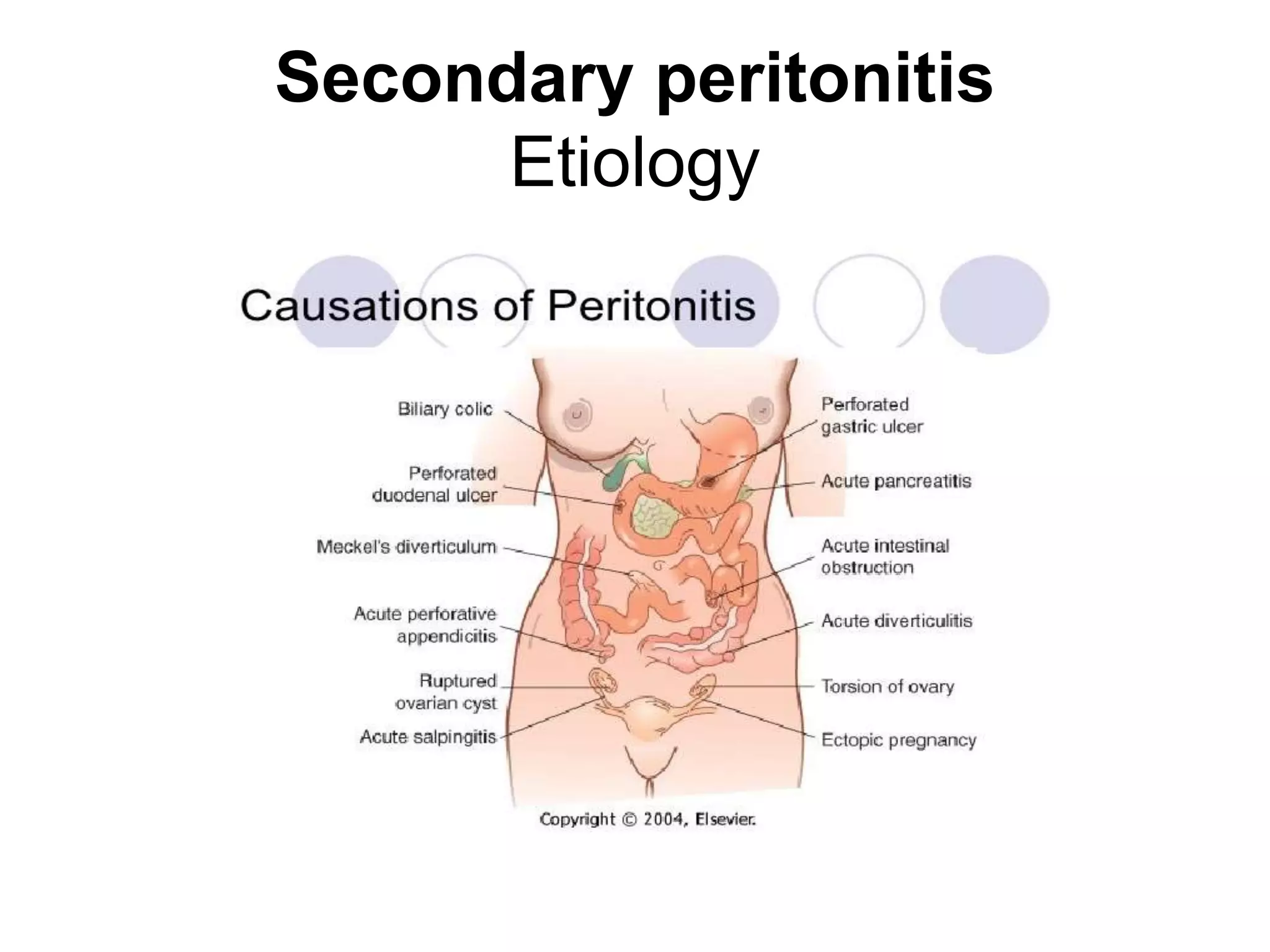 Peritonitis.ppt