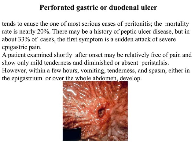 Peritonitis.ppt | Digestive Disorders | Diseases and Conditions