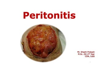 Peritonitis Seminar pptx | PPTX